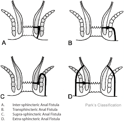 Fistler ved Crohns sygdom, diagnostik og behandling af